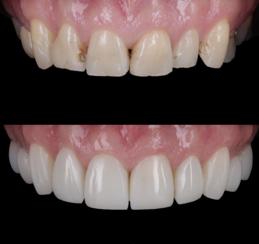 Composite Bonding For Sensitive Teeth - Cambridge Dental